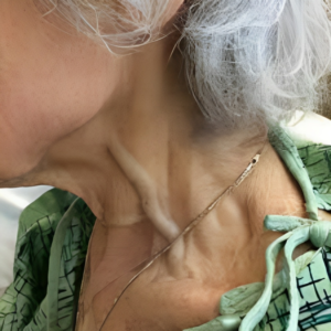 What is Beck’s Triad and Why is it Important? - The Nurse Page